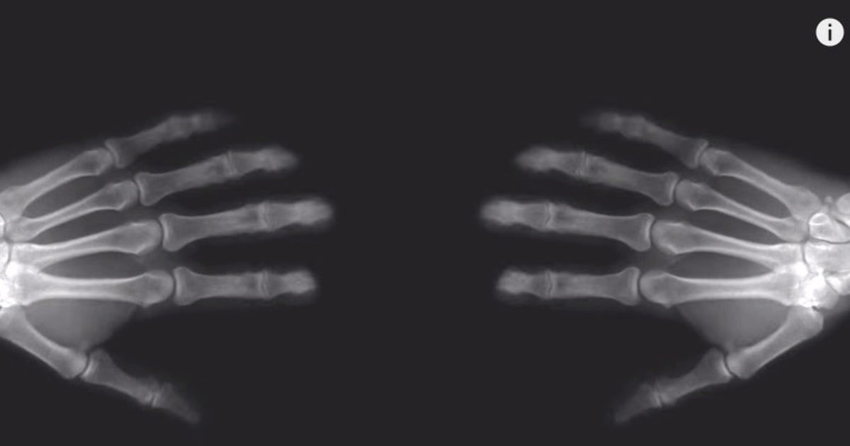 Un homme a craqué ses doigts sur une main et pas l'autre pendant 60 ans ...